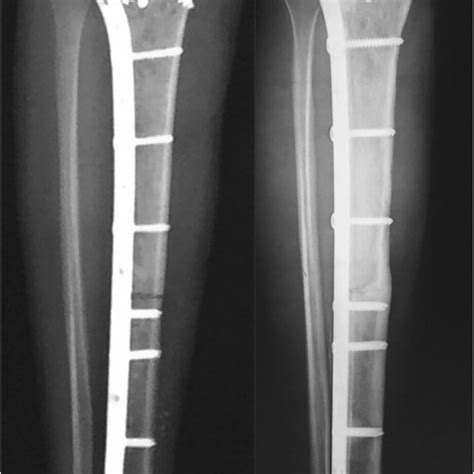 Pdf Uncemented Three Dimensional Printed Prosthetic Reconstruction For Massive Bone Defects Of