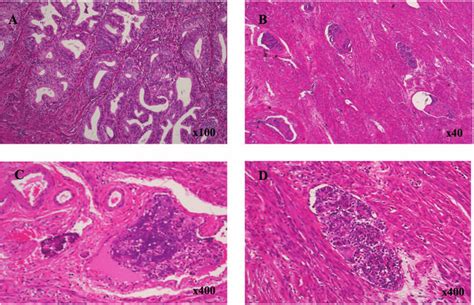 A Tissue Sections From The Complex Atypical Endometrial Hyperplasia Download Scientific