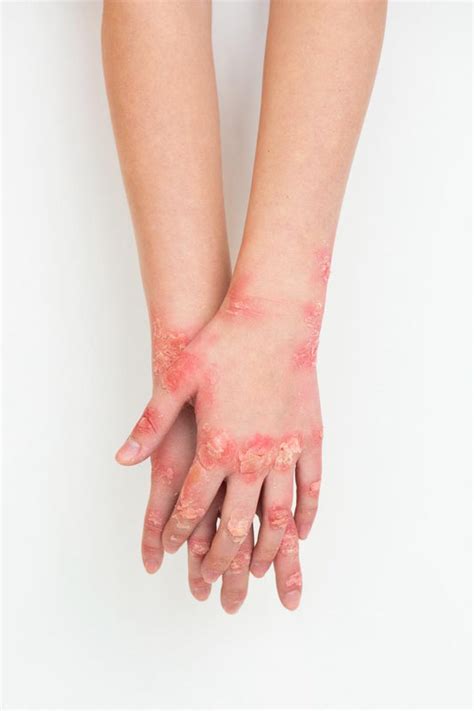 Best Skincare Routine For Psoriasis Swaarnim Ayurveda