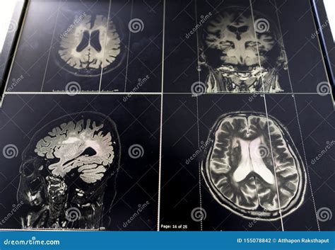 Brain Atrophy For Education And Diagnostic Stock Photo Image Of Atrophy Everyone