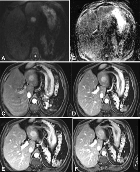 A And B Lesion Appear Hyperintense In DWI With Signal Drop In ADC