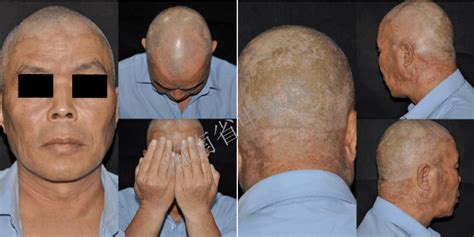 刘爱民教授皮肤病辨治典型案例分享（46）—慢性光化性皮炎1例皮损