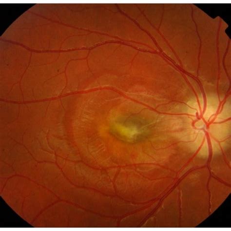 Fibrous Choroidal Neovascularization In The Papillomacular Bundle Download Scientific Diagram
