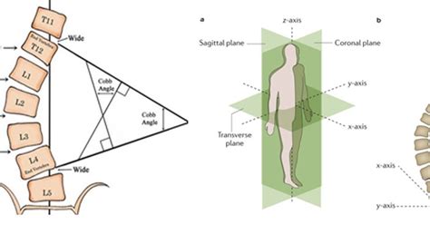 Scoliosis Skoliosis Pengukuran Derajat Scoliosis Cobb Angle
