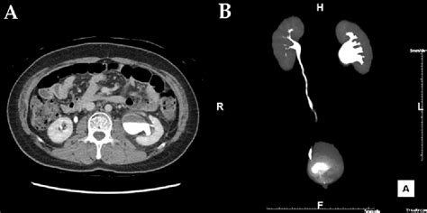 Figure 1 From Urothelial Cell Carcinoma Of The Renal Pelvis