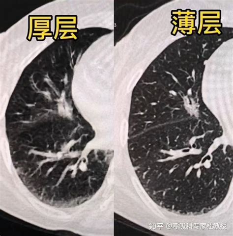 为什么体检查出肺结节后，建议再做一次薄层ct？随访≠没事！ 知乎