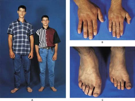 Gigantism Causes Symptoms Diagnosis And Treatment