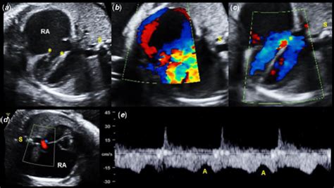 A B Four Chamber View Showing A Markedly Enlarged Right Atrium Ra