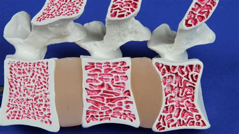 Bone Marrow Derived Stem Cell Therapy