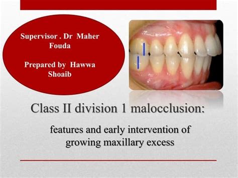 Class Ii Malocclusion Ppt