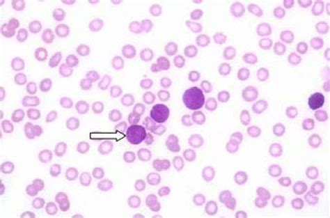 Figure 1 From Early Lineage Switch From T Acute Lymphoblastic Leukaemia