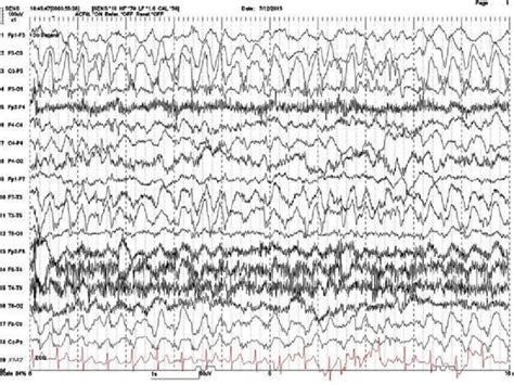 One Hundred Twenty Seconds After Onset Of Secondarily Generalized