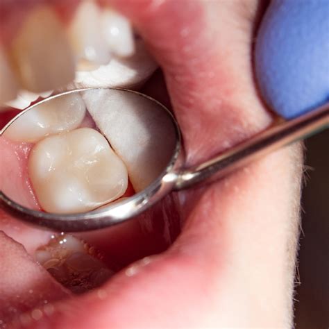 Buat Janji Tindakan Medis Prosedur Medis Perawatan Medis Inlay