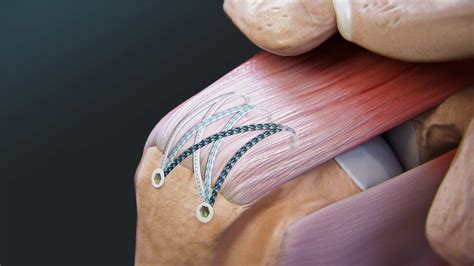Arthrex Fibertak® Speedbridge™ Rotator Cuff Repair