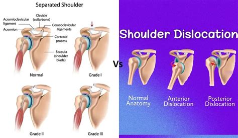 Shoulder Separation Vs Dislocation How Do They Differ Difference Camp
