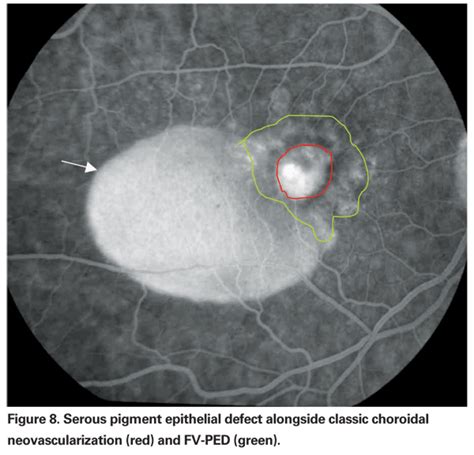 Fluorescein Angiography In Neovascular Amd
