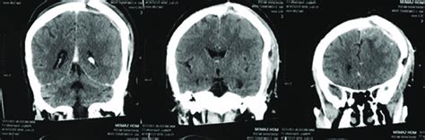 Postoperative Contrast Enhanced Computed Tomography Head Coronal