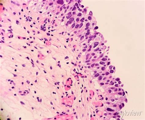Urinary Bladder Biopsy Showing A Urothelial Carcinoma In Situ • Wall