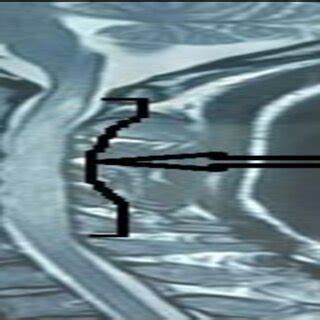 T2 Hyperintense MRI Of Cervical Spinal Cord Showing Involvement Of