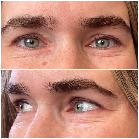 Upperlower Bleph Or Brow Lift Rplasticsurgery