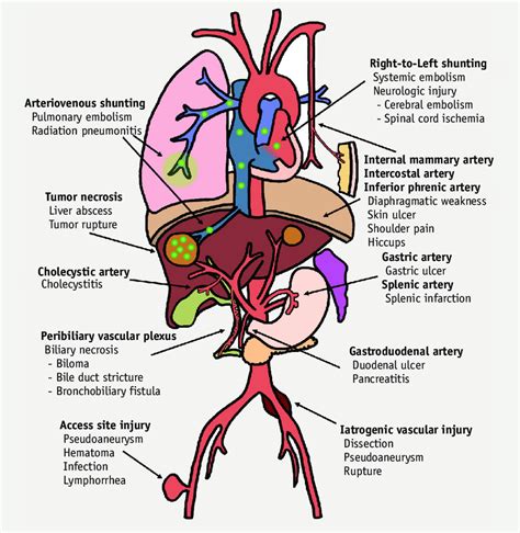 Illustration Of Complications Related To The Transarterial Treatment Of