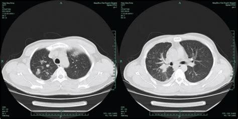 Pulmonary Co Infection With Cryptococcus Neoformans And Myco