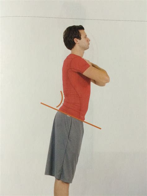 Lower Crossed Syndrome A Postural Distortion Syndrome Characterized By