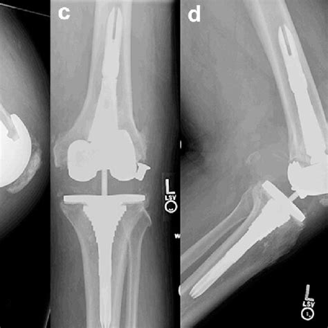 Anteroposterior Ap A And Lateral B Radiographs Obtained At