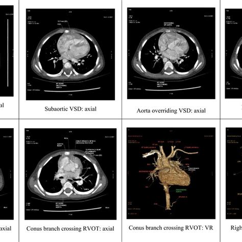 Rvot Covered With Autologous Pericardial Patch Download Scientific Diagram