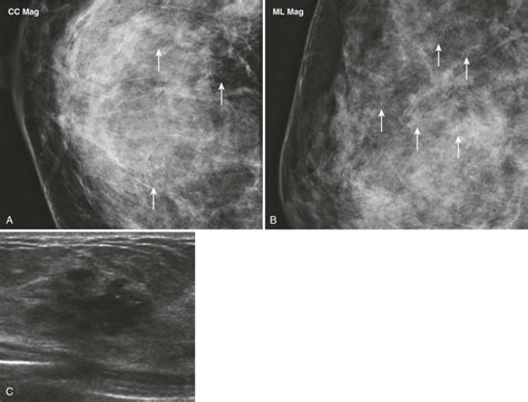 Calcifications Made Easy Radiology Key