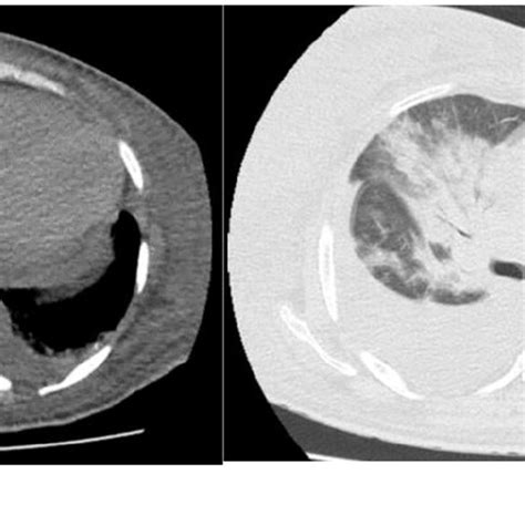 A Ncct Chest Demonstrating Bilateral Pleural Effusions Right Left Download Scientific