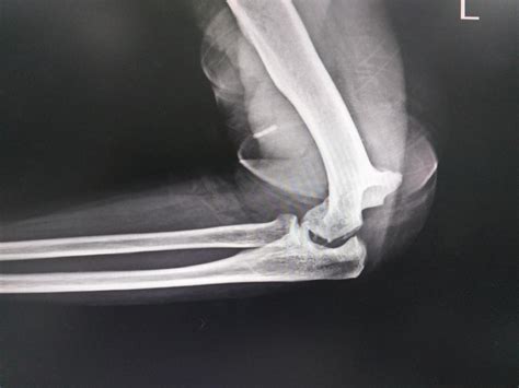 Imagen De Rayos X De Dislocación De La Articulación Del Codo 15763180