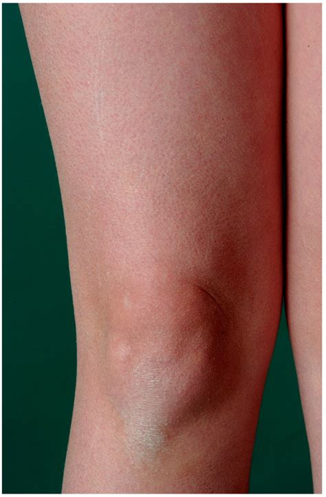 Ichthyoses—a Clinical And Pathological Spectrum From Heterogeneous