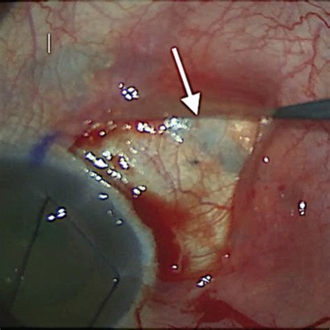 A Shows Scleral Thinning Evident After Conjunctival Dissection White