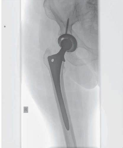 Femoral Neck Fractures Hemiarthroplasty And Total Hip Arthroplasty