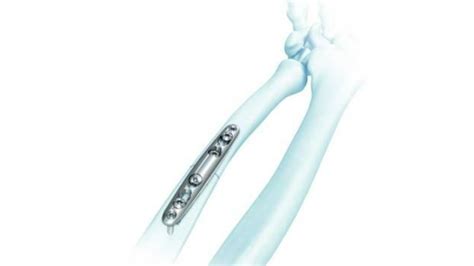 Lcp™ Ulna Osteotomy System 2 7 Mm Products Depuy Synthes