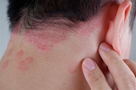 Bệnh Vảy Nến Nguyên Nhân Triệu Chứng Và Cách điều Trị Hoàn Mỹ