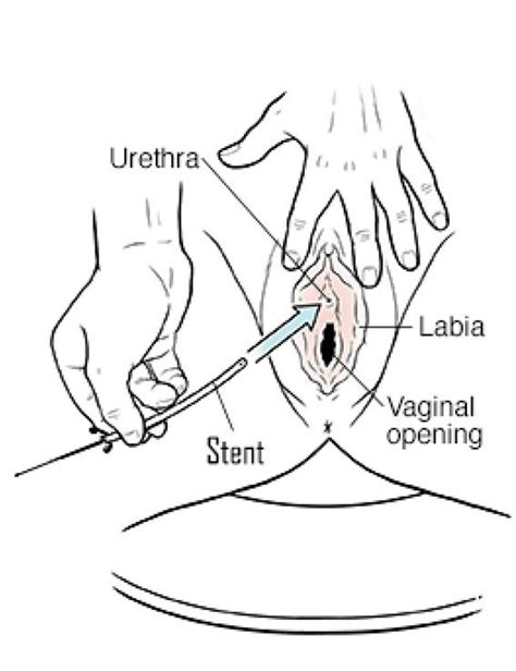 GUIDE Fabricate Female Stent Incontinent Desires DD Boards Chat