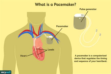 External Pacemaker Circuit Diagram
