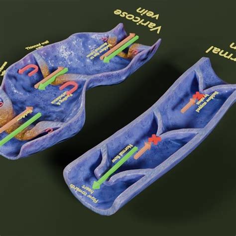 ⚕️ Varicose Vein Valve・ Stl File For 3d Printing・cults