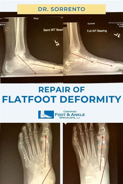 Flatfoot Deformity Ankle Surgery Flat Feet Deformed Sorrento Clinic Repair Active Life