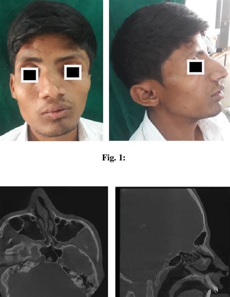 Figure 3 From Treacher Collins Syndrome Semantic Scholar