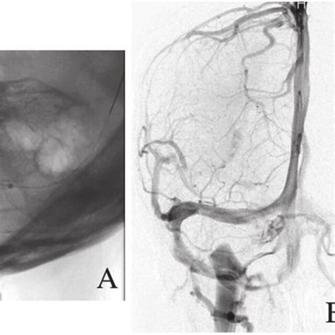 A Precise Was Placed In The Transverse Sinus In The Frontal B And
