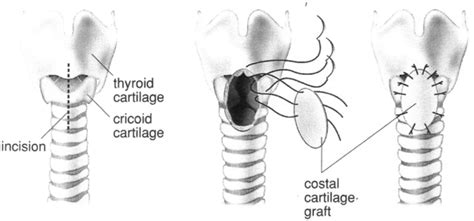 Laryngotracheal Reconstruction Costal Cartilage Graft Download