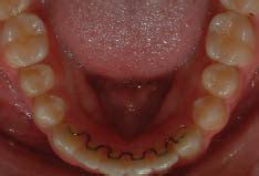 The V Loop Bonded Lingual Retainer Oral Health Group