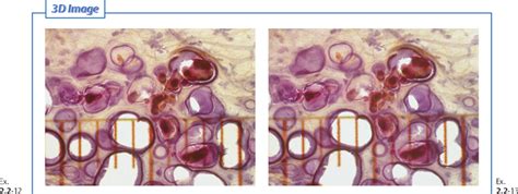 Group 1 One Or Two Clusters Of Crushed Stone Like Calcifications Of The Mammogram Produced By