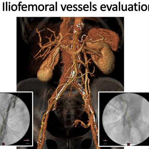 Evaluation Of The Right Axillary Artery As Cannulation Site For