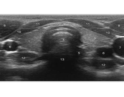 Thyroid Landmarks Quiz
