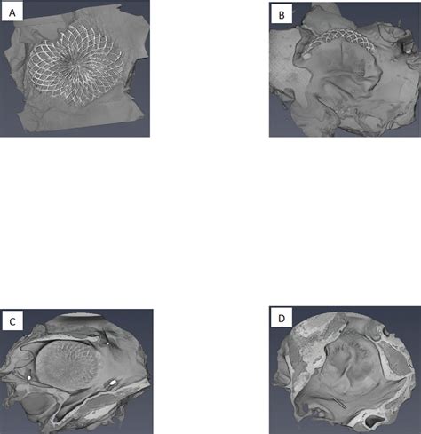 Figure 5 From Assessment Of Nit Occlud Atrial Septal Defect Occluder Device Healing Process