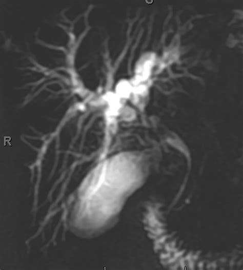 Endoscopic Evaluation And Management Of Cholangiocarcinoma Gastroenterology Clinics